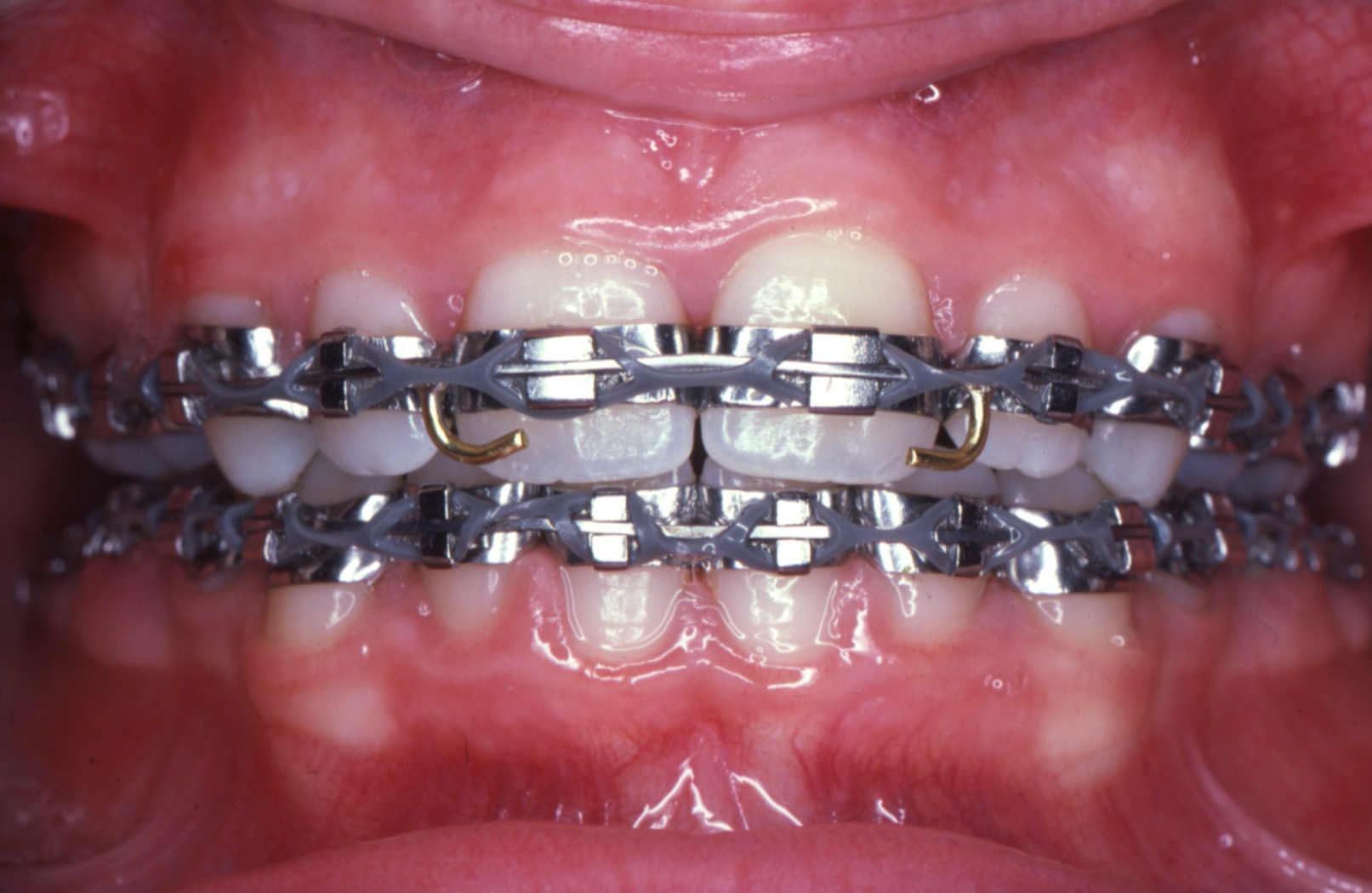 Was er vroeger ook orthodontie - beugel