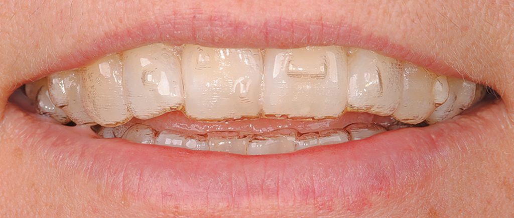 Clear Aligners - beugel